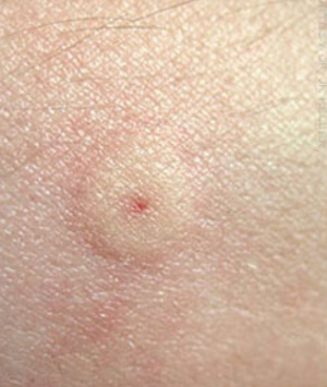 What Is The Difference Between A Normal And Allergic Reaction To An ...